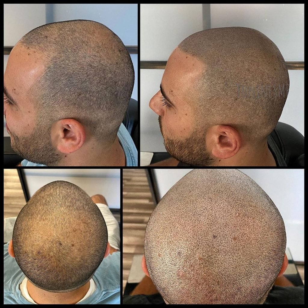 Topline SMP | Scalp Micropigmentation Cherry Hill